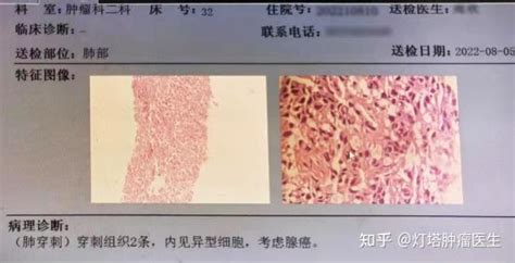 基因检测报告从没有突变到检测到突变，让肺癌患者用上靶向药 知乎