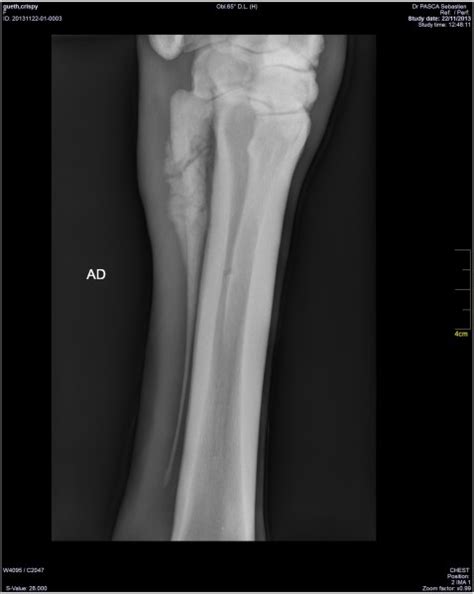 Fracture Du Métacarpien Rudimentaire