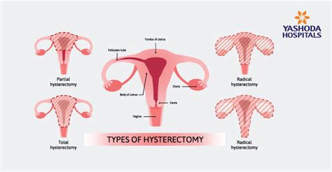 Ovarian Cancer Early Signs Detection And Treatment Yashoda Hospitals