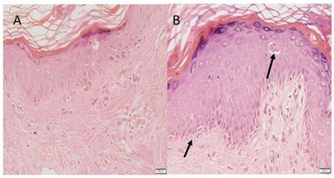 Acute Cutaneous Gvhd Grade 2 Prominent Melanin Pigment Incontinence Is