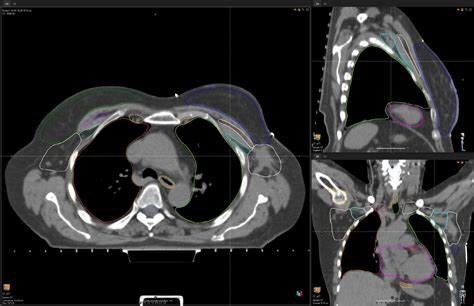 Deep Learning Segmentation Model Catalogue By RaySearch Laboratories Issuu