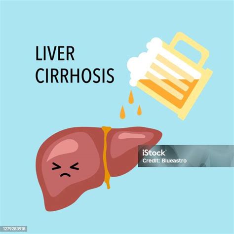 맥주 나 알코올 음료를 마시면 간이 손상 될 수 있습니다 간경변 질환 벡터 일러스트 헬스케어 개념 간 내부 기관에 대한 스톡 벡터 아트 및 기타 이미지 Istock