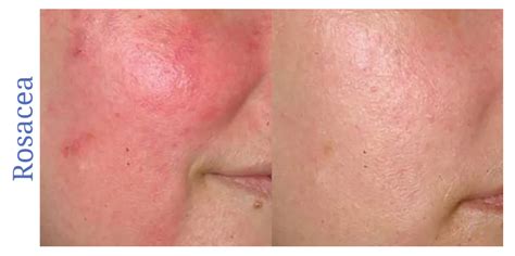 Micro Needling Facial With Stem Cells Hannah Spa