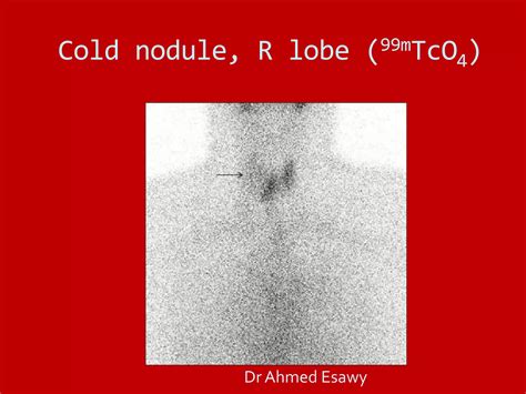Thyriod Gland Imaging Part 5 Molecular Imaging Nuclear Imaging Spect