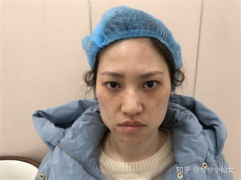 做了皮秒后，才知道原来可以这么美 知乎