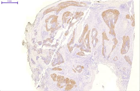 Photomicrograph Of Oscc Tissue Stained With Anti P53 Antibody And