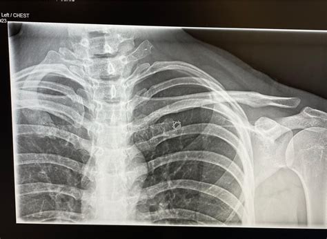 My X Ray Minus A First Rib Thanks Thoracic Outlet Syndrome Rradiology