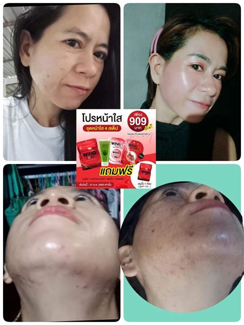 สกินแคร์ วิ้ง ไม่ ต้ อ ง กั ง ว ล ผิ วมั น ผิ ว แ ห้