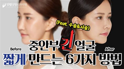 중안부 긴얼굴 길어보이는 얼굴 짧아보이게 확 줄여주는 6가지 방법 성형꿀팁 Youtube