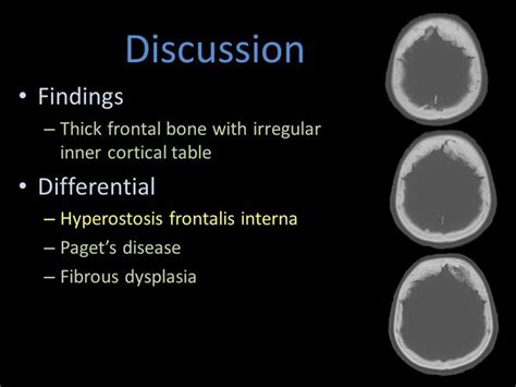 Pin By Hussein Allaw On Ddx Pagets Disease Medication Management Radiology