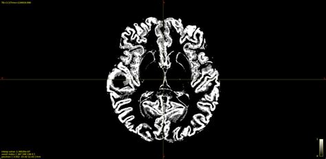 5ttgen Segmentation Is Wrong For Pathological Tissue Mrtrix3 Community