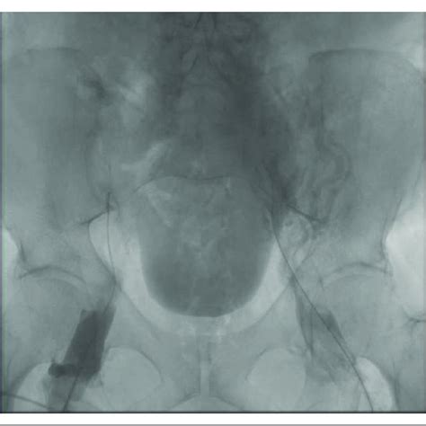 Venogram Of Bilateral Femoral And Iliac Veins On Admission Download Scientific Diagram