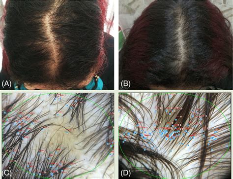 Clinical Pictures Of A 25‐year‐old Female With Fphl Grade I A At