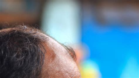 Best Oil For Receding Hairline Growth Tips