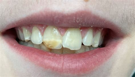 La Mih Chez Les Enfants Dentiste Nice Implants Dentaires Nice Cabinet Dentaire Du Dr Diss