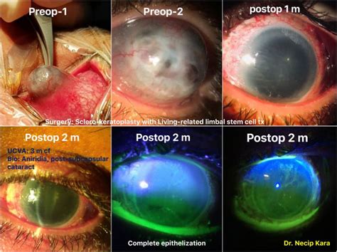 Early Postoperative Appearance Of Sclero Keratoplasty With Living