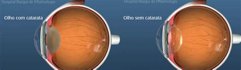 Cirurgia De Catarata Em Curitiba Oftalmologia Barigui