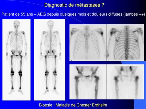 Ppt Scintigraphie Osseuse Powerpoint Presentation Free Download Id 1389988
