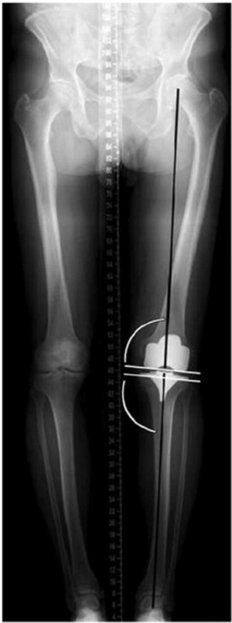 A Long Leg Radiograph Showing Measurement Of The Position Of The