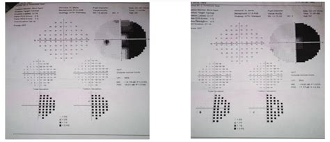 Right Absolute Homonymous Hemianopia Denoting A Left Optic Tract