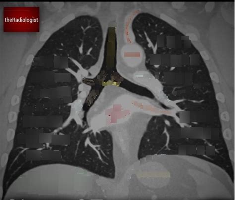 Chest CT Coronal Diagram Diagram Quizlet