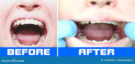 Wisdom Teeth Before And After