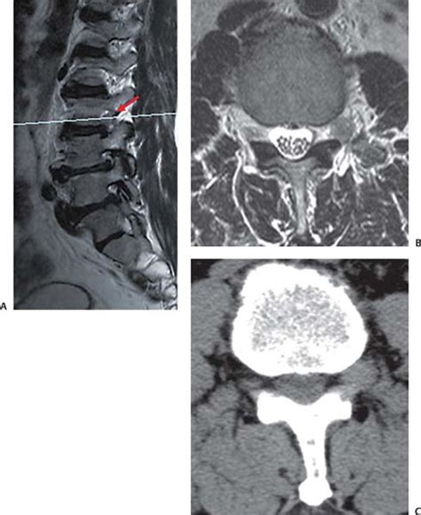 18 Case Presentations And Surgical Technique Percutaneous Endoscopic