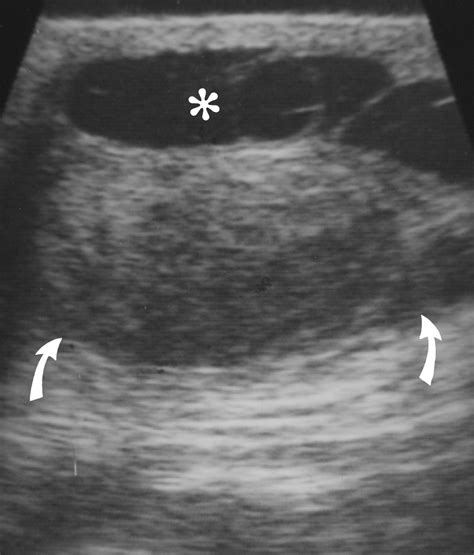 Gross Appearance Of Epididymo Orchitis