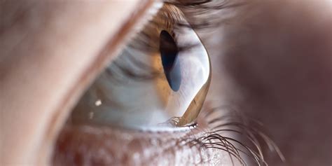 C3r Treatment For Keratoconus Marketing Media Hub Free Health
