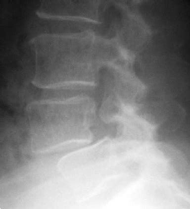 Pedicle Fracture L5