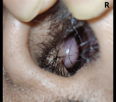 Are These Nasal Polyps Rnasalpolyps