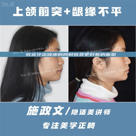 杭州正畸丨隐适美改善侧貌轮廓，解除“封印”重现你的美！ 知乎