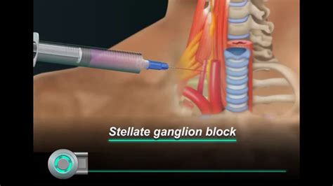 Stellate Ganglion Block Youtube