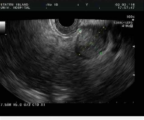 Endoscopic Ultrasound Endoscopic Ultrasound Image Showing 21 X 18 Cm