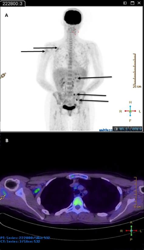 Prolonged Febrile Illness Following First Dose Of Chadox1 Bmj Case