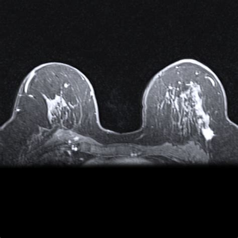 Merit Launches Wire Free Breast Localization Device Auntminnieeurope