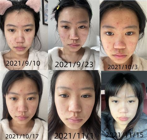 脸上痘痘没了，留下的痘印该怎么办？ 知乎