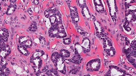 Carcinoma Mypathologyreport