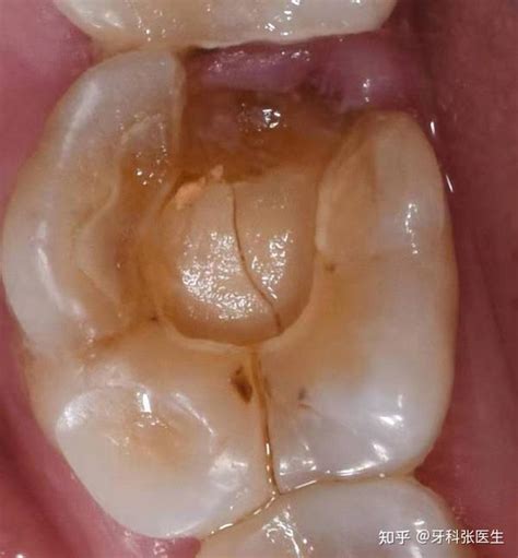 为什么牙医都建议根管治疗后的牙齿做牙套呢 知乎