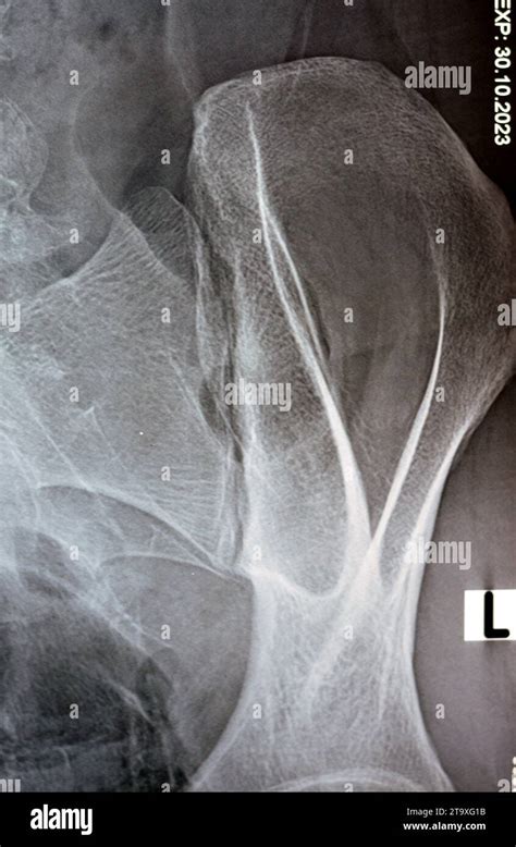 Sacroiliac Joint Digital Radiograph Examination X Ray Reveals Preserved