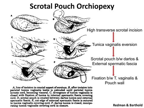 Torsion Testis Operative Chat Pptx