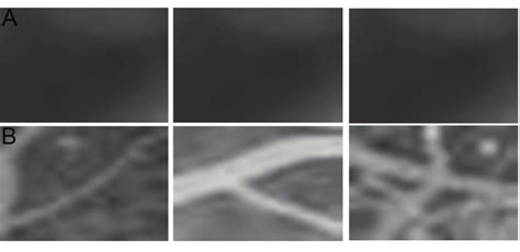 A Patches Of Non Perfused Areas B Patches Of Other Parts Of The