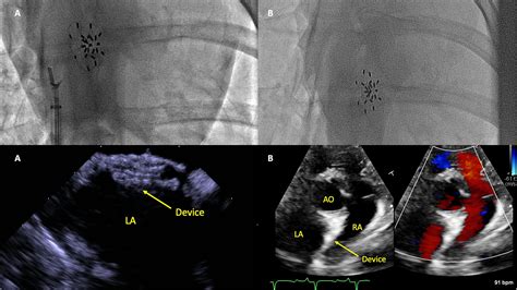 Performance Safety And Biocompatibility Of A Novel Pfo Closure Device