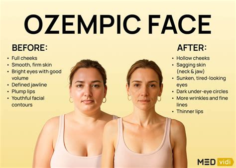 “ozempic Face” And Facial Ageing After Rapid Weight Loss What It Is And How We Treat It In