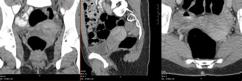 Was Trying To See If I Could Find My Retrocecal Appendix On My Old Er Ct Scans And Got Reminded