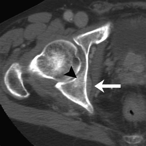Example Of Extraosseous Mass Of Bone Metastasis In An 82 Year Old Male Download Scientific