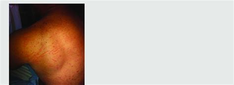 Erythematous Maculopapular Rash On The Trunk And Extremities Download Scientific Diagram