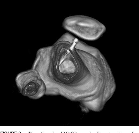 Figure 1 From Placement Of Tibial Intraosseous Infusion Devices Semantic Scholar