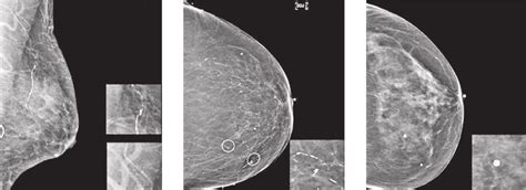 Breast Calcifications а The Double Linear Contour Of Calcifications