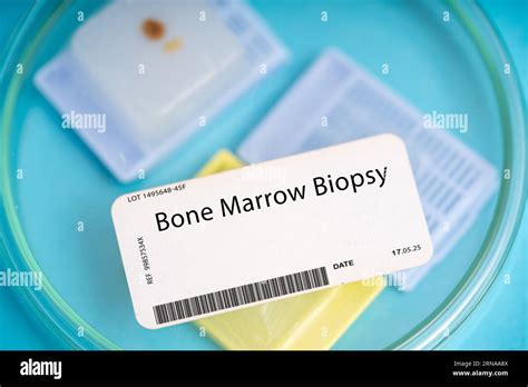 Bone Marrow Biopsy A Small Sample Of Bone Marrow The Spongy Tissue